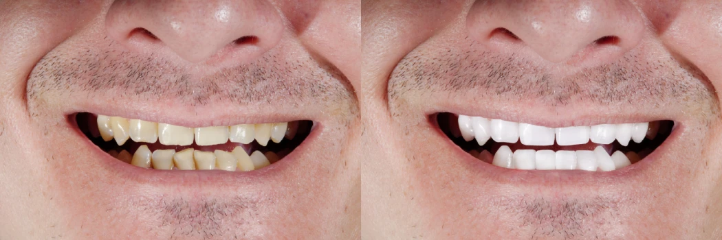 Dental Plaque - Causes and Methods of Removal