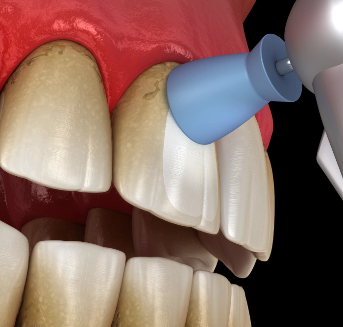 Dental Plaque - Causes and Methods of Removal