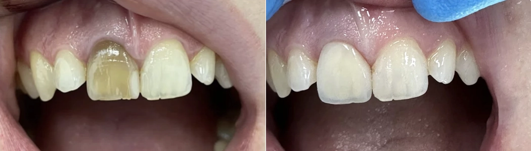 Tooth Nerve Removal – Is It Painful, The Consequences, How the Nerve Is ...