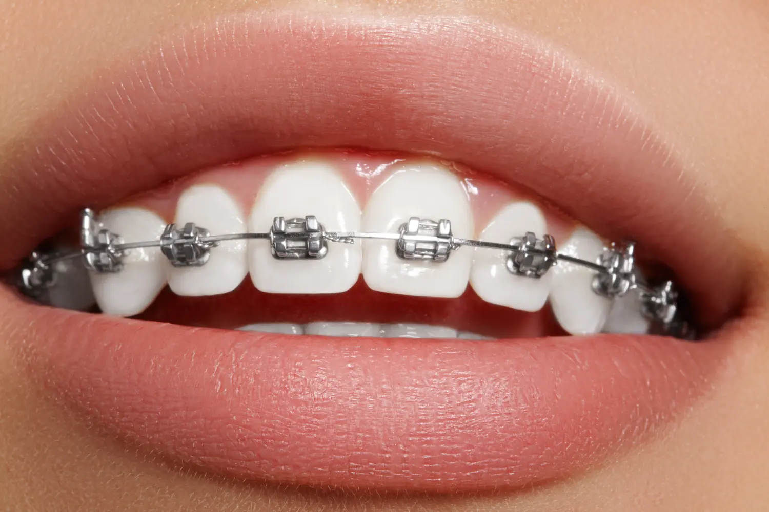 Braces for the Upper Jaw – Indications, Types, Fitting Procedures
